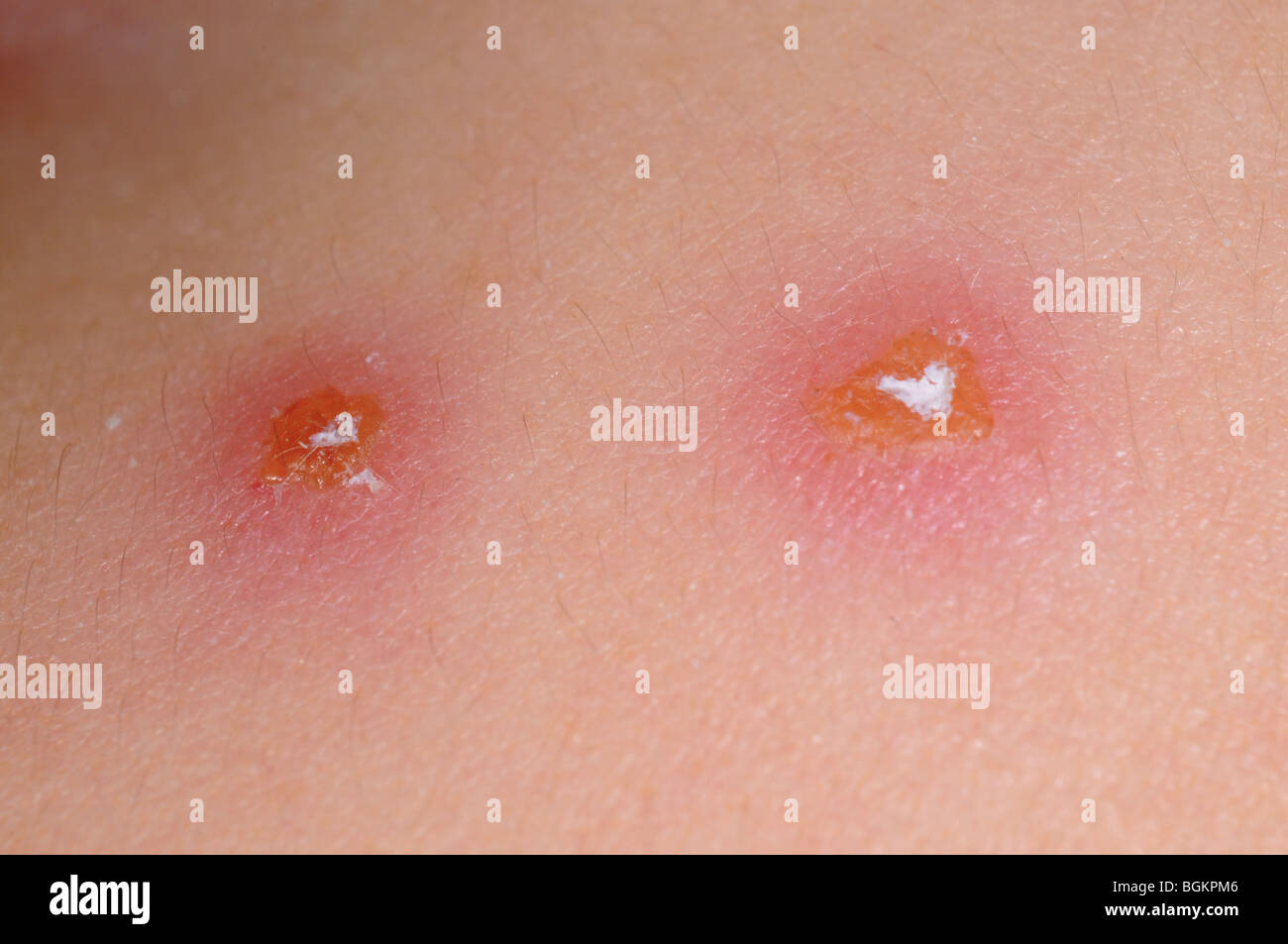 Herpes vesicles immagini e fotografie stock ad alta risoluzione - Alamy