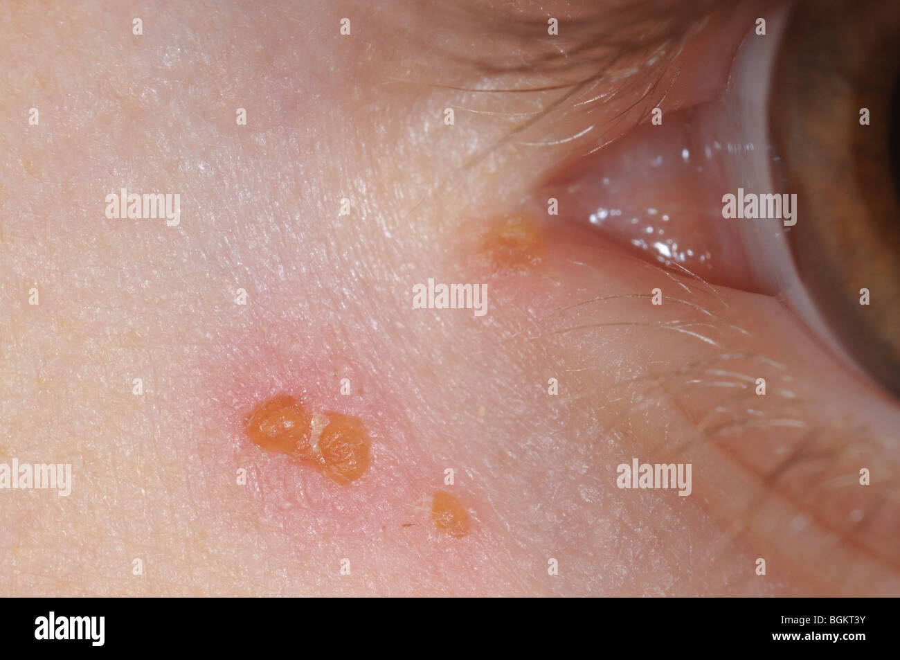 Herpes vesicles immagini e fotografie stock ad alta risoluzione - Alamy