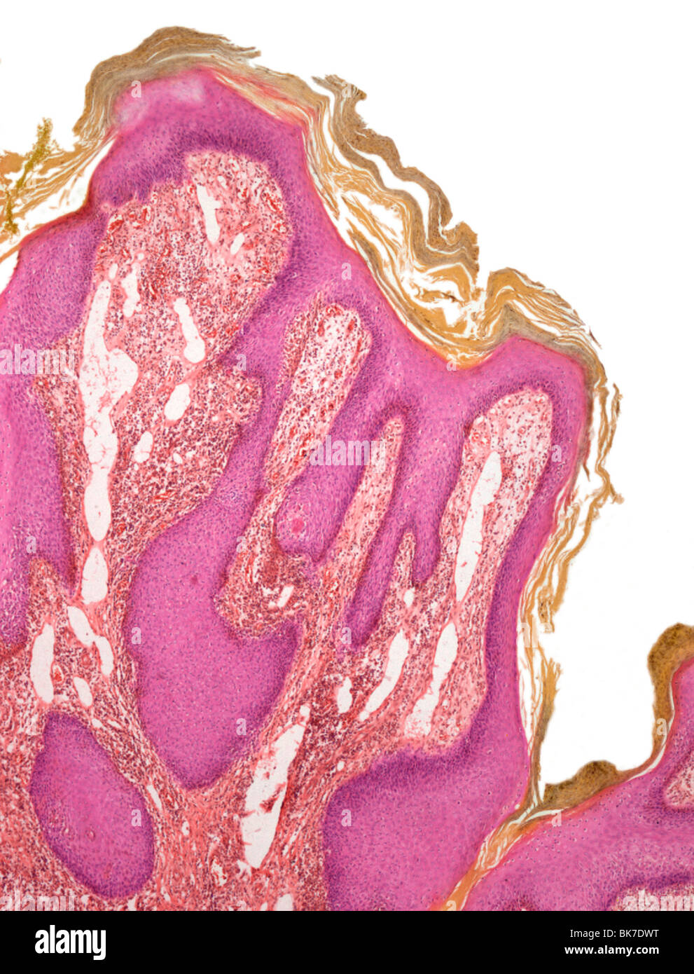 Verruca vulgaris immagini e fotografie stock ad alta risoluzione - Alamy