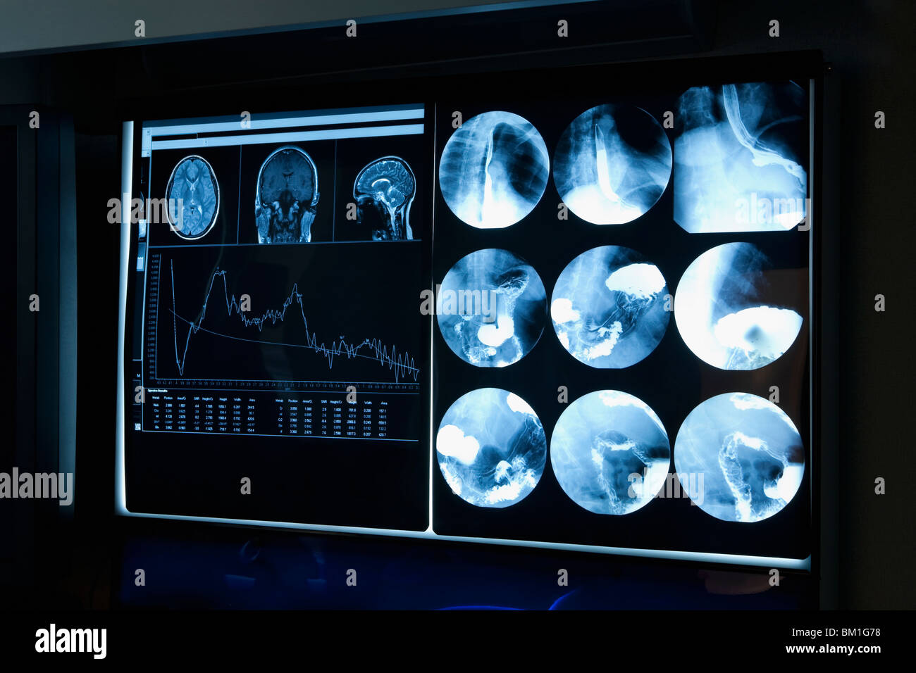 Primo piano della scansione mri del cervello umano immagini e ...