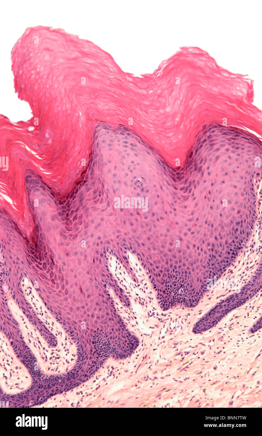 Verruca vulgaris immagini e fotografie stock ad alta risoluzione - Alamy