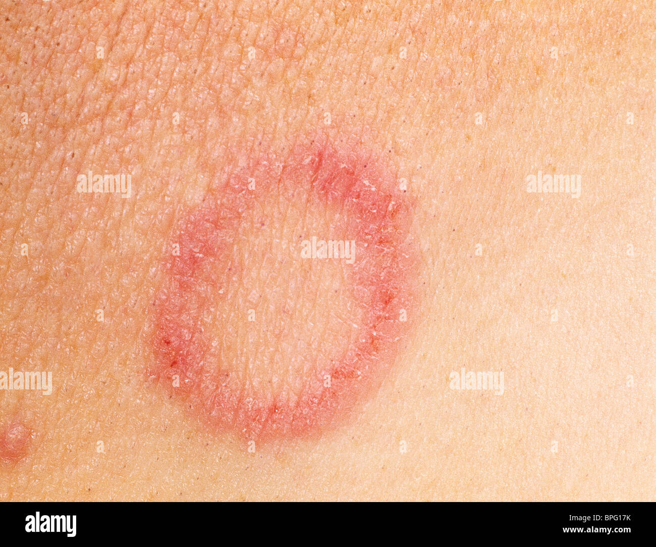 Infezione da tigna immagini e fotografie stock ad alta risoluzione - Alamy