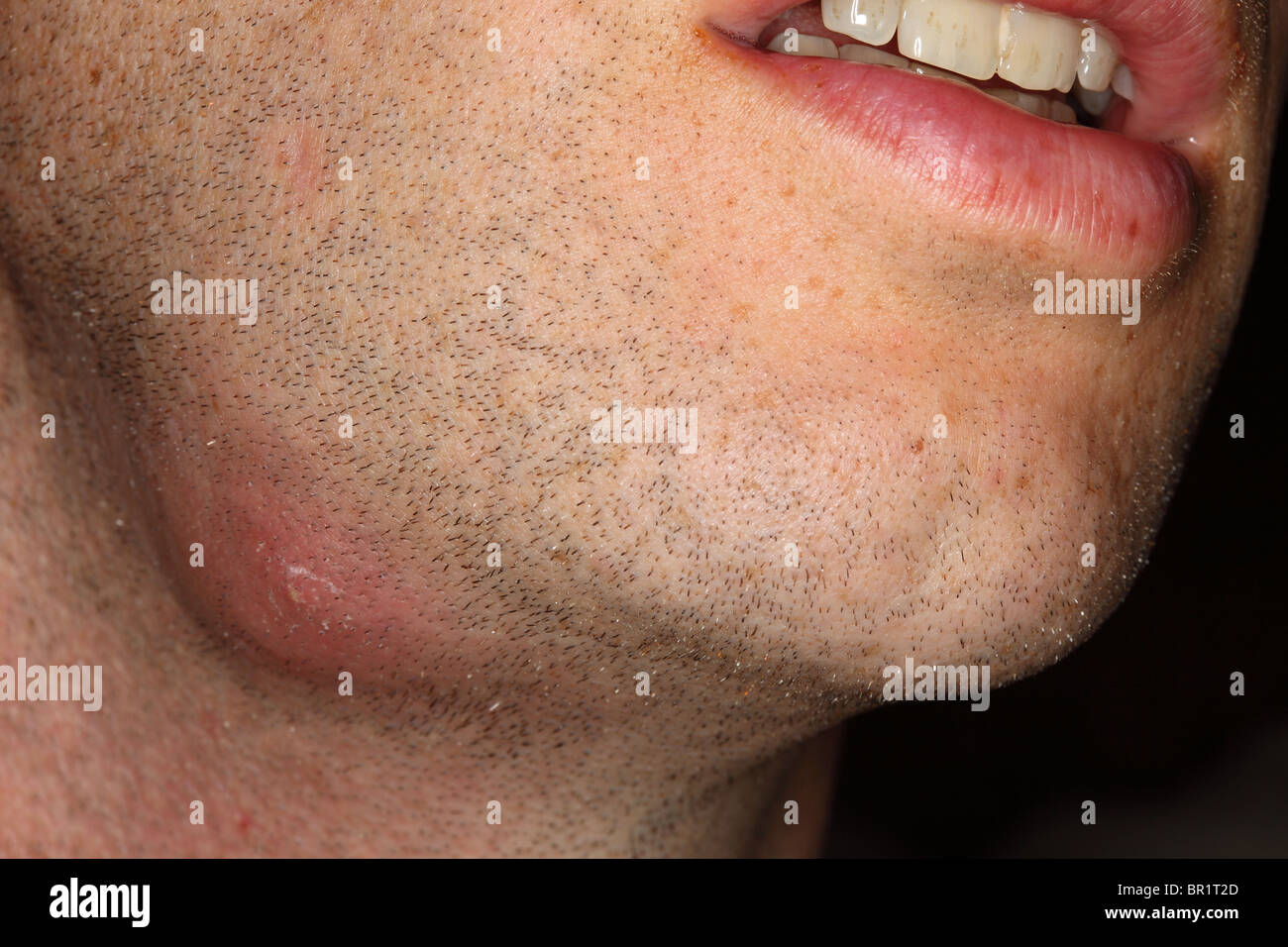 Ascesso cutaneo immagini e fotografie stock ad alta risoluzione - Alamy