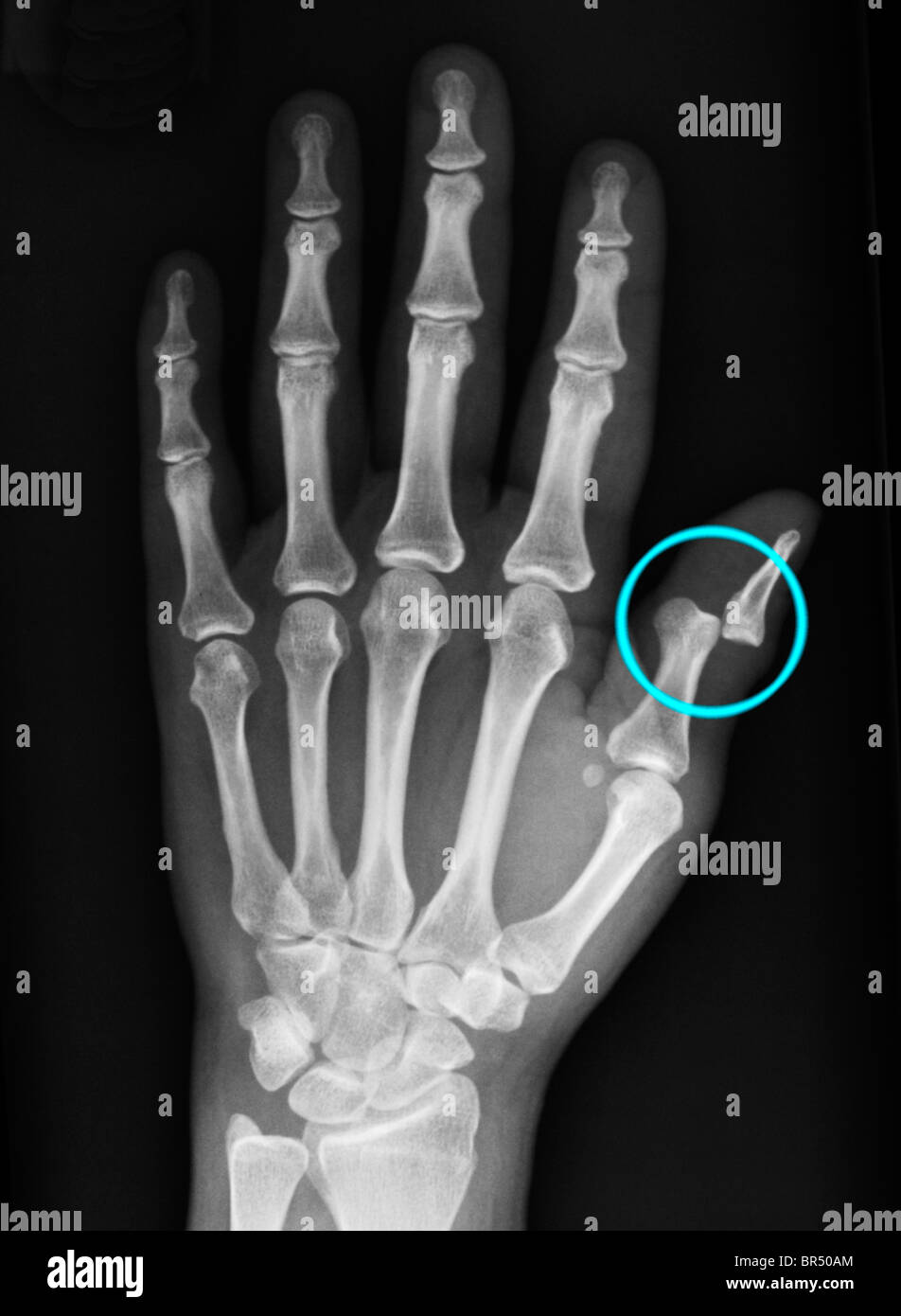 Mano x-ray di 36 anno vecchia donna che mostra una lussazione della ...