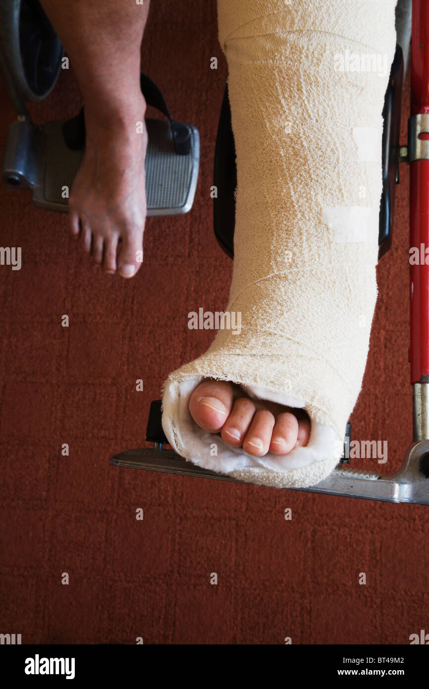 Piede ingessato immagini e fotografie stock ad alta risoluzione - Alamy
