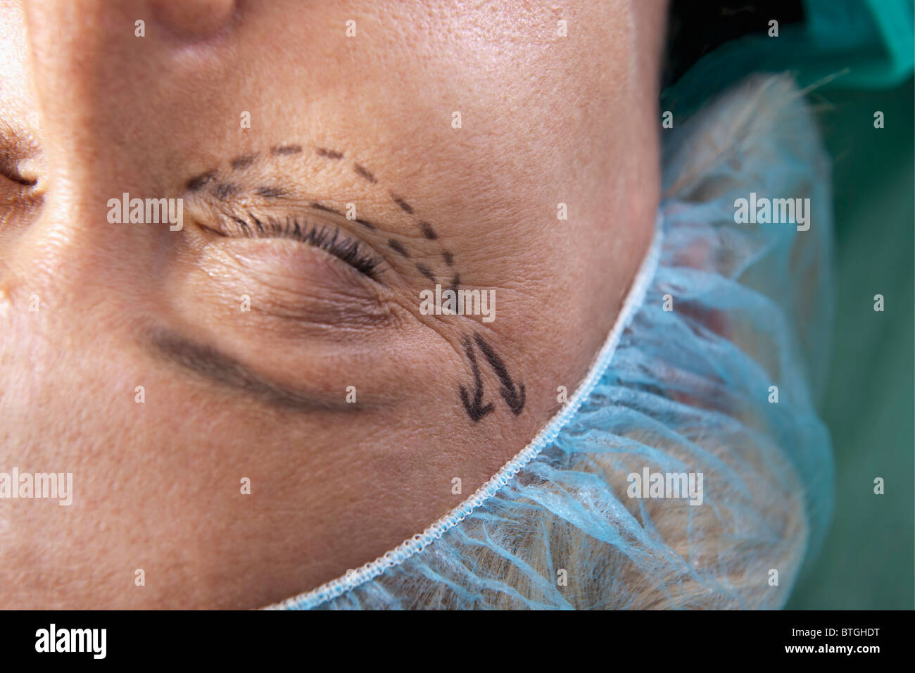Incision mark immagini e fotografie stock ad alta risoluzione - Alamy