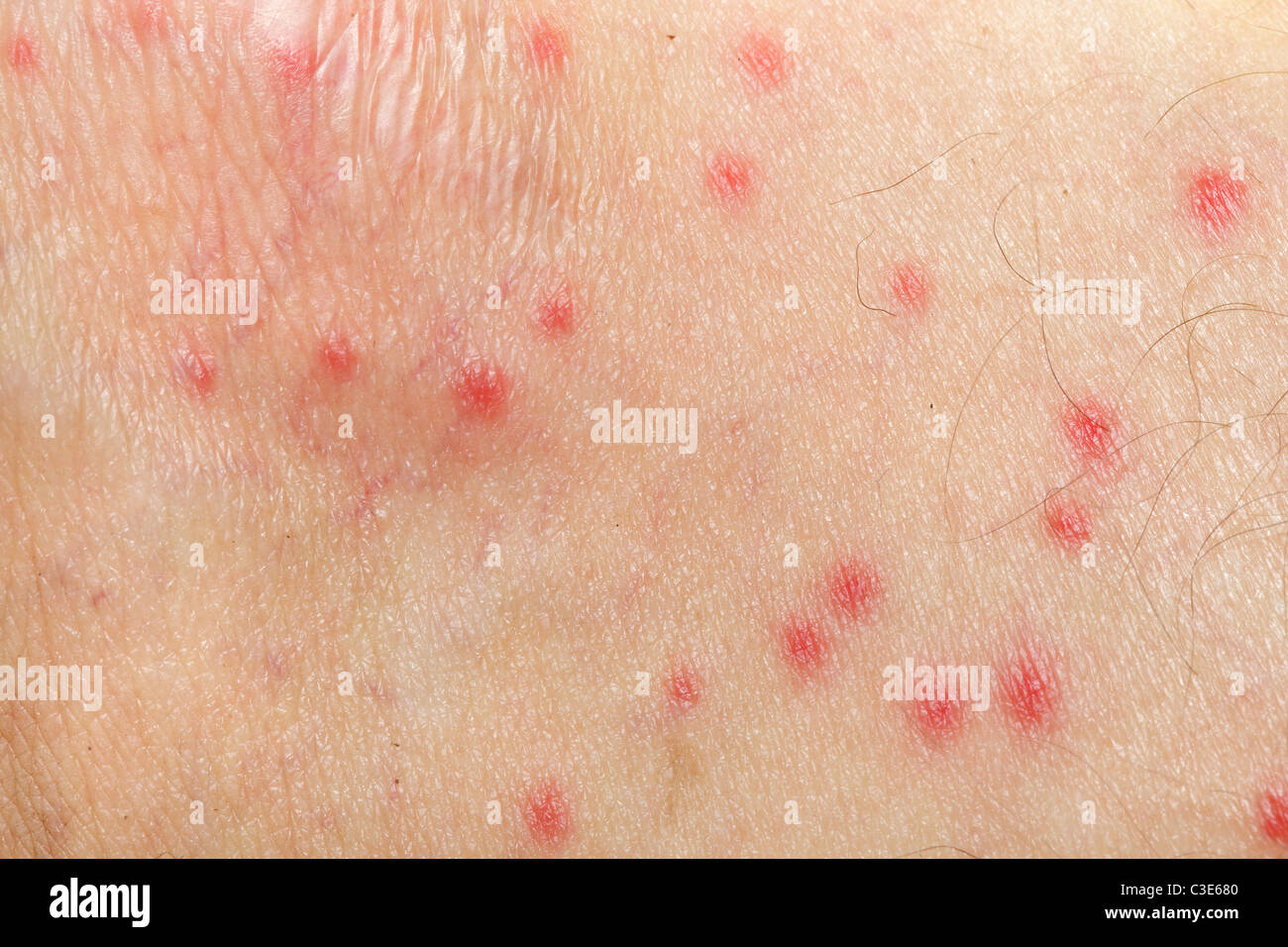 Punture di insetti immagini e fotografie stock ad alta risoluzione - Alamy