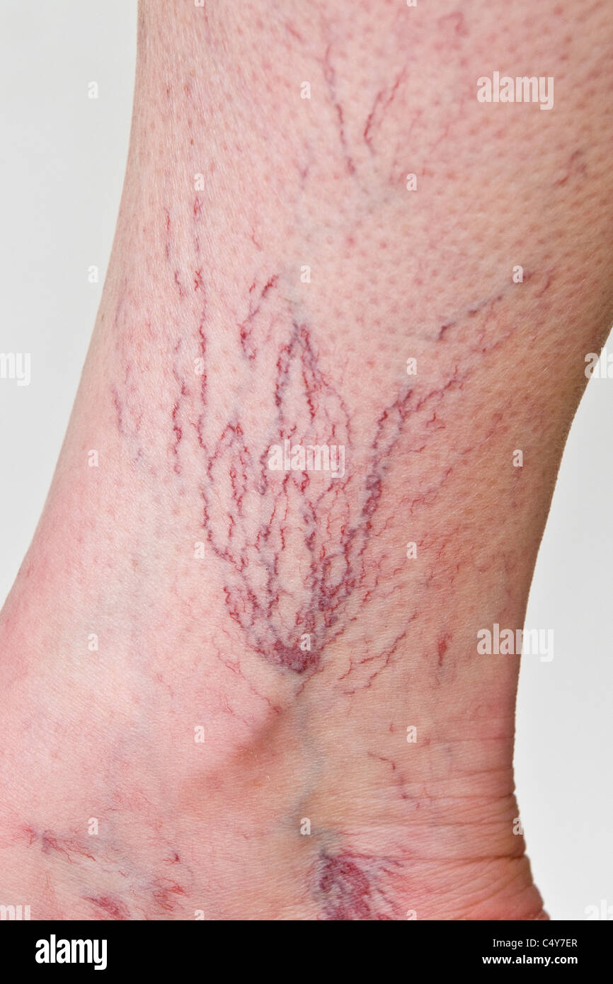 Capillari e vene immagini e fotografie stock ad alta risoluzione - Alamy