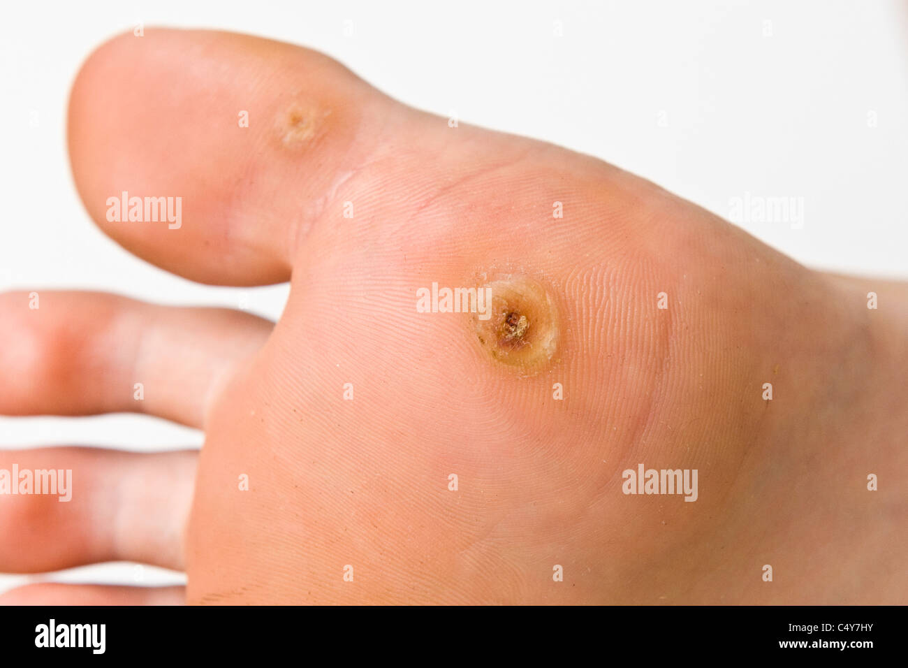 Verruca del piede immagini e fotografie stock ad alta risoluzione - Alamy