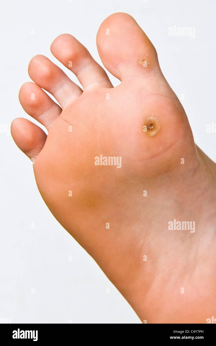 Verruca wart foot immagini e fotografie stock ad alta risoluzione - Alamy