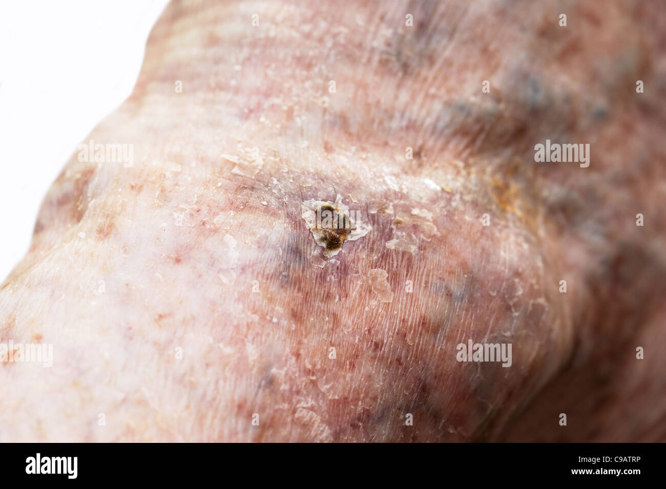 Ulcera venosa immagini e fotografie stock ad alta risoluzione - Alamy