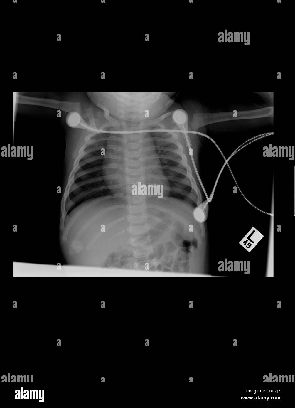 Costola fratturata immagini e fotografie stock ad alta risoluzione - Alamy
