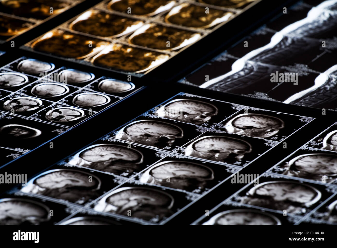 Arteria cerebrale a raggi x angiogramma immagini e fotografie stock ad ...