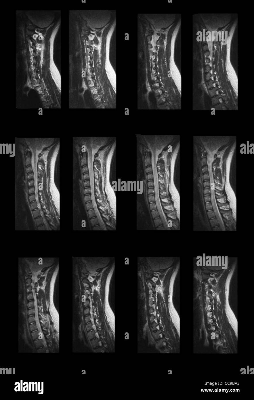 Radiografia del rachide cervicale immagini e fotografie stock ad alta ...