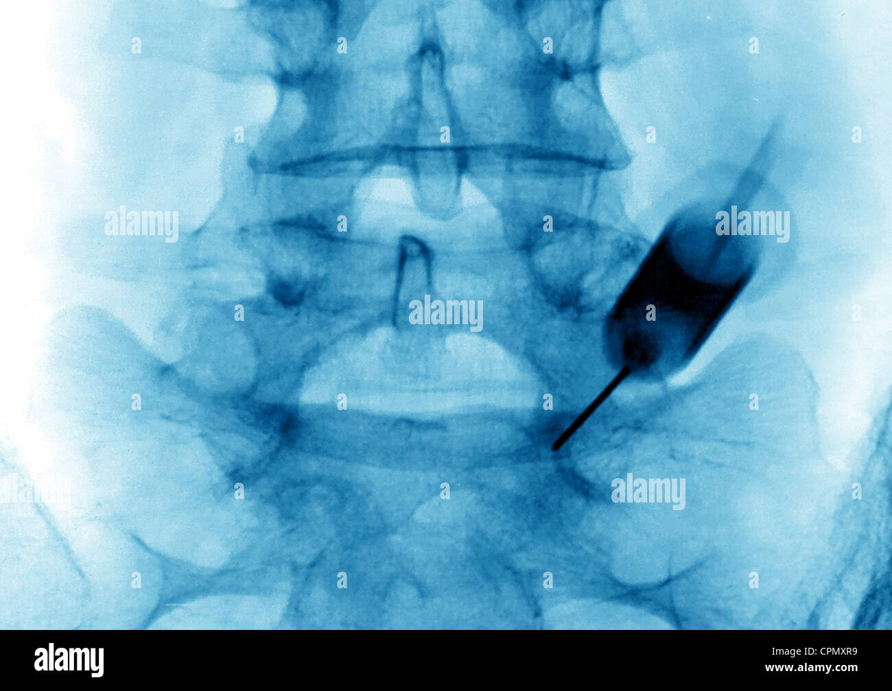 Vertebre lombari immagini e fotografie stock ad alta risoluzione - Alamy