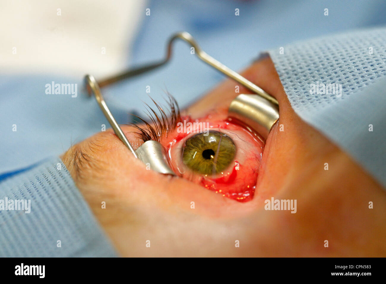 Strabismo strabico immagini e fotografie stock ad alta risoluzione - Alamy