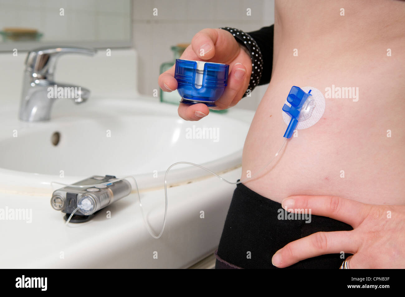 Pompa Per Infusione Ambulatoriale Esterna Di Insulina