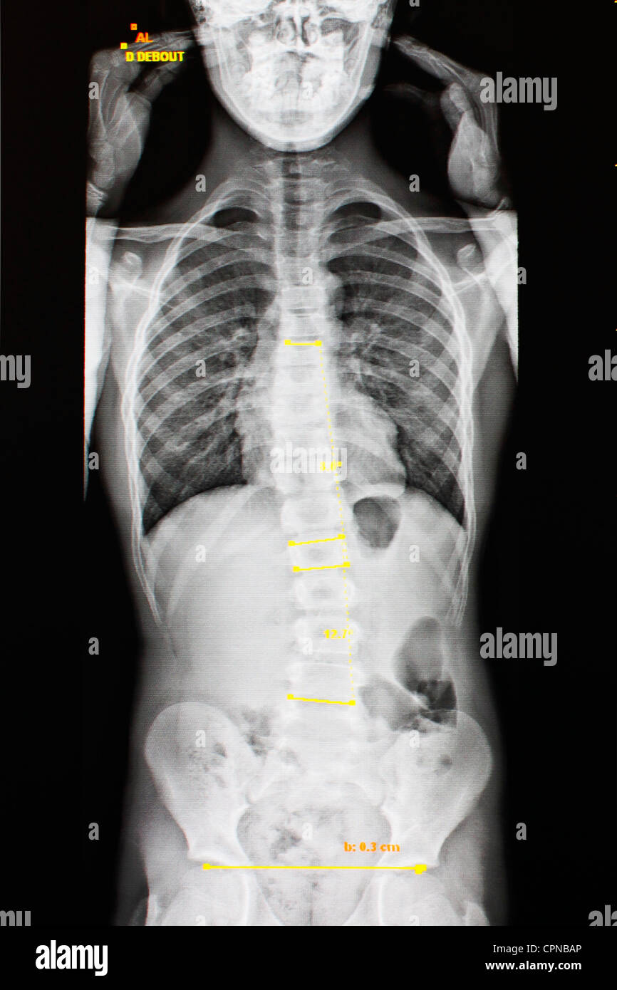 Radiografia della scoliosi immagini e fotografie stock ad alta ...