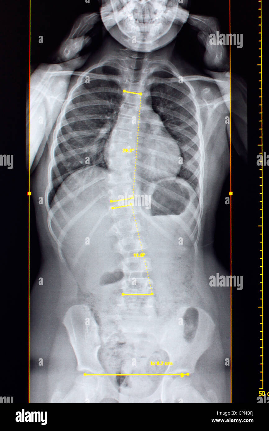 Radiografia della scoliosi immagini e fotografie stock ad alta ...