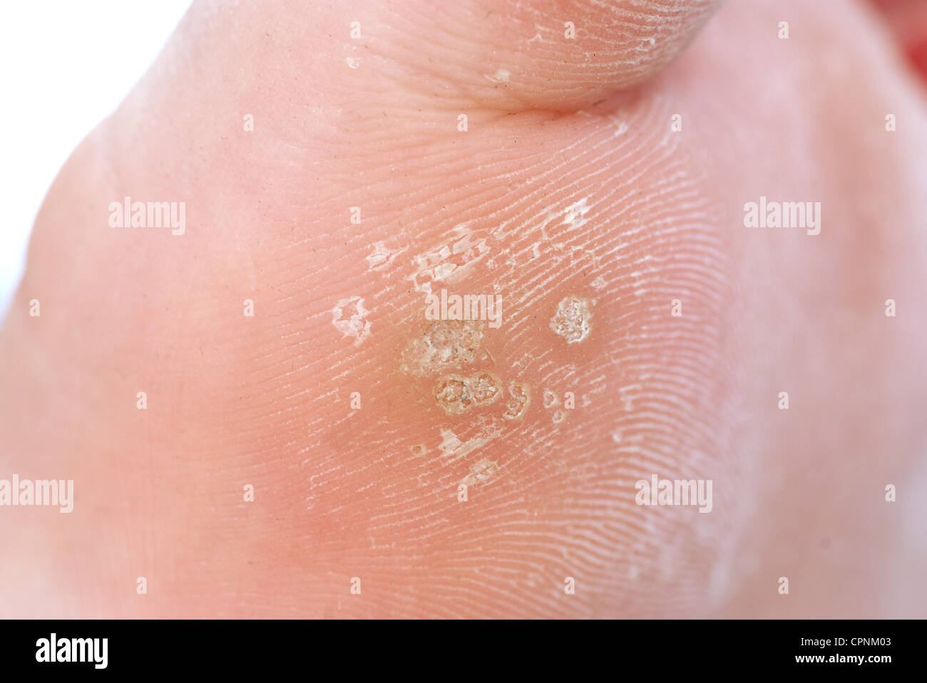 Verruca plantare immagini e fotografie stock ad alta risoluzione - Alamy