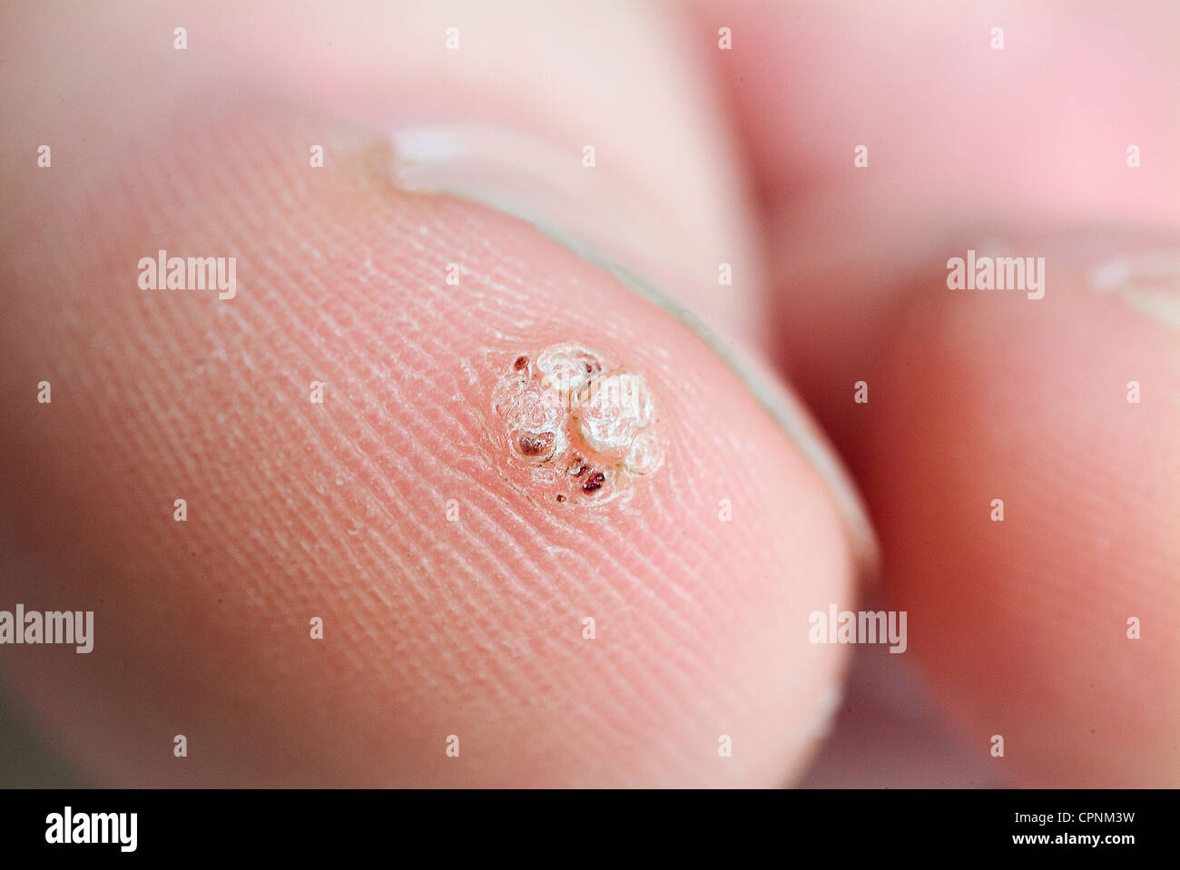 Verruca del piede immagini e fotografie stock ad alta risoluzione - Alamy