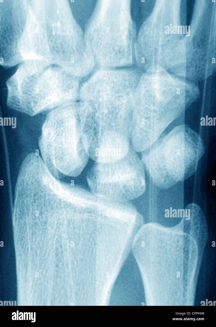 Radiologia polso immagini e fotografie stock ad alta risoluzione - Alamy