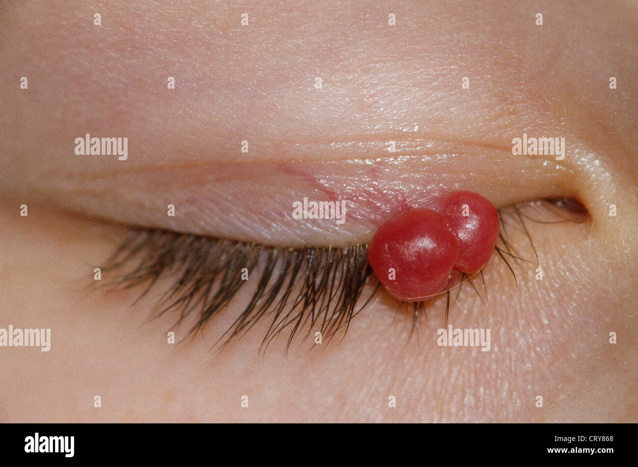 Tumore dell'angioma immagini e fotografie stock ad alta risoluzione - Alamy