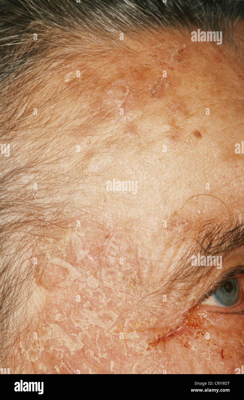 Eritema multiforme immagini e fotografie stock ad alta risoluzione - Alamy