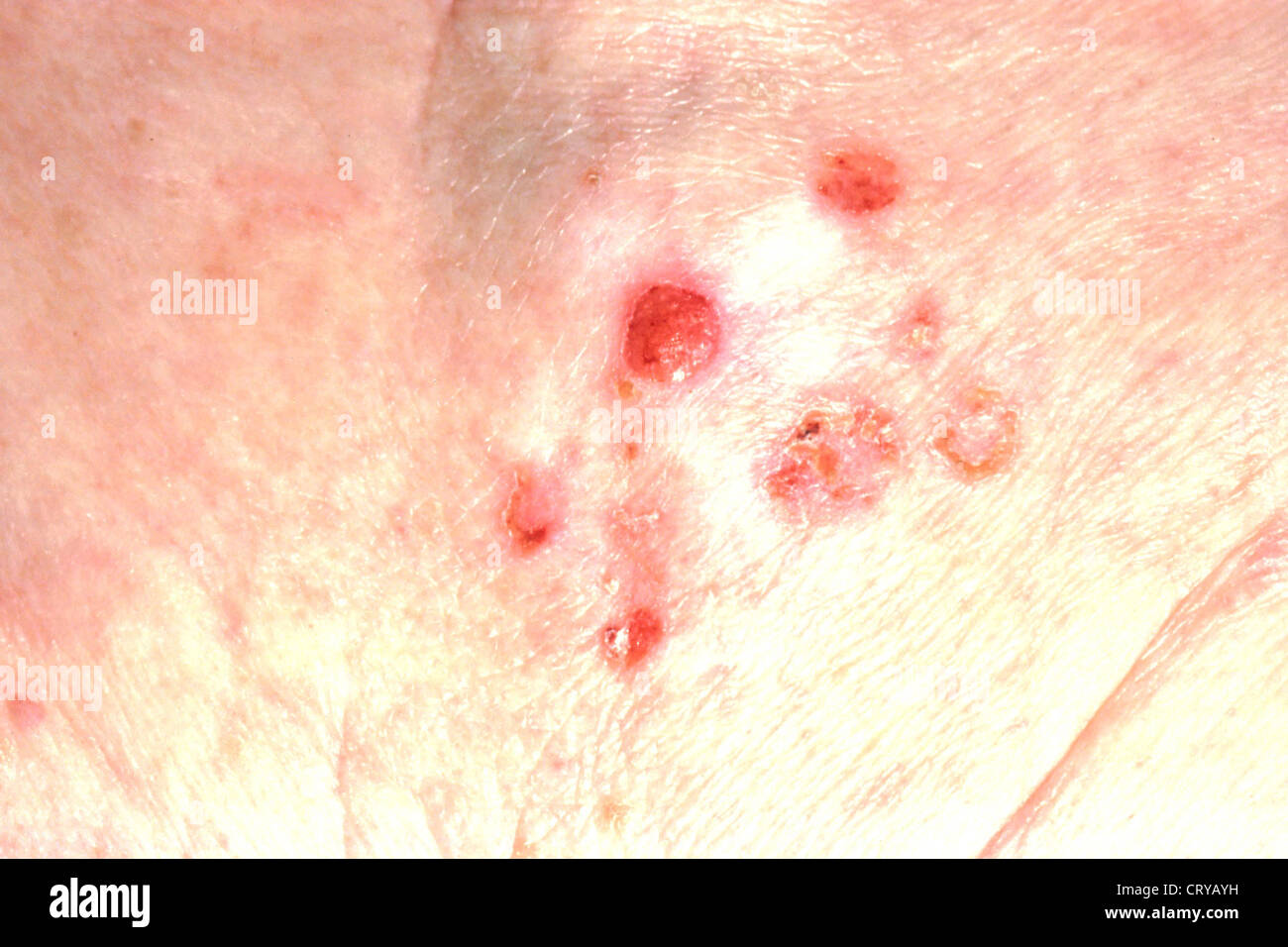 Basal cell carcinoma bcc immagini e fotografie stock ad alta ...