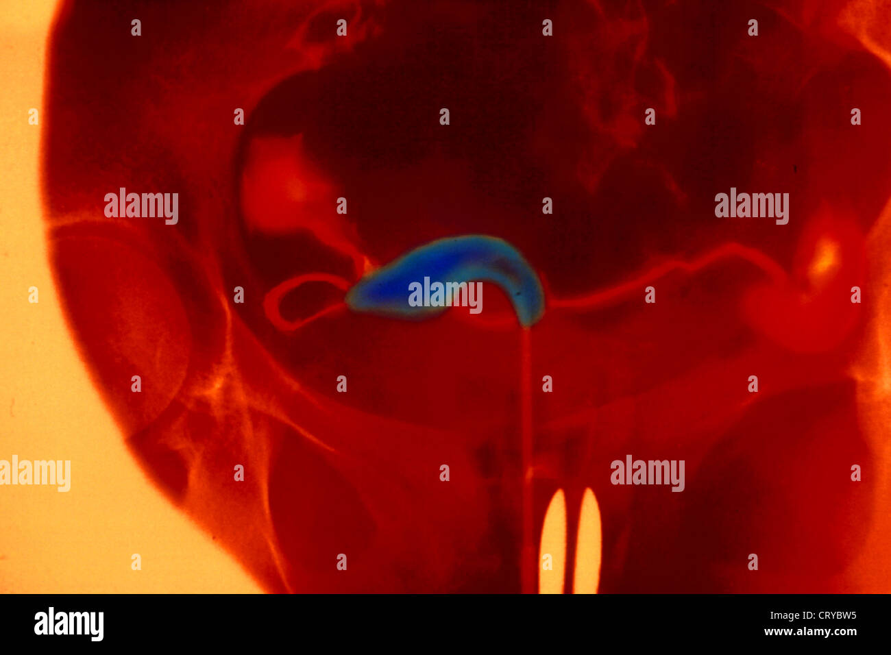 Utero retroverso immagini e fotografie stock ad alta risoluzione - Alamy