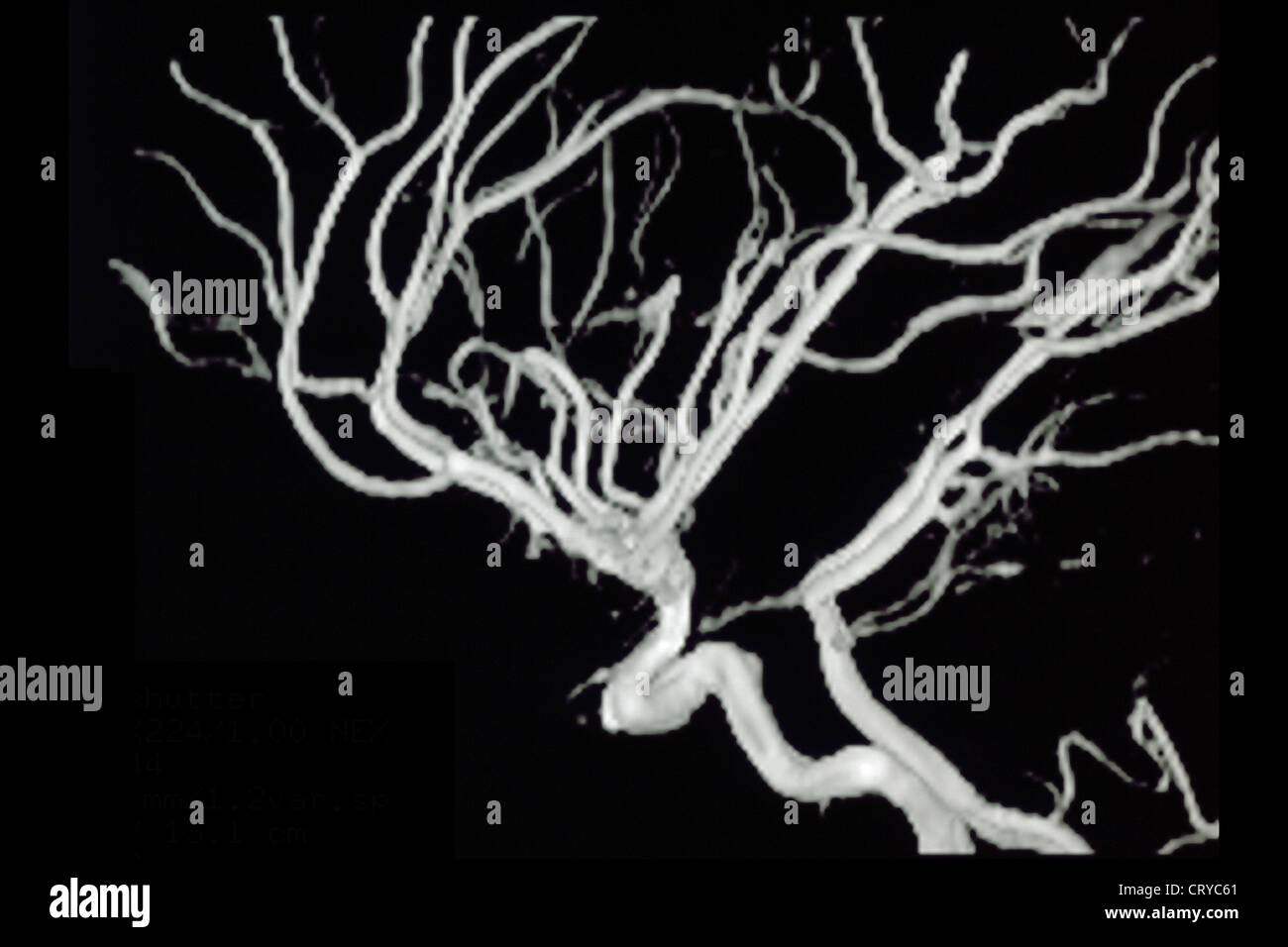 Circolo arterioso di willis immagini e fotografie stock ad alta ...