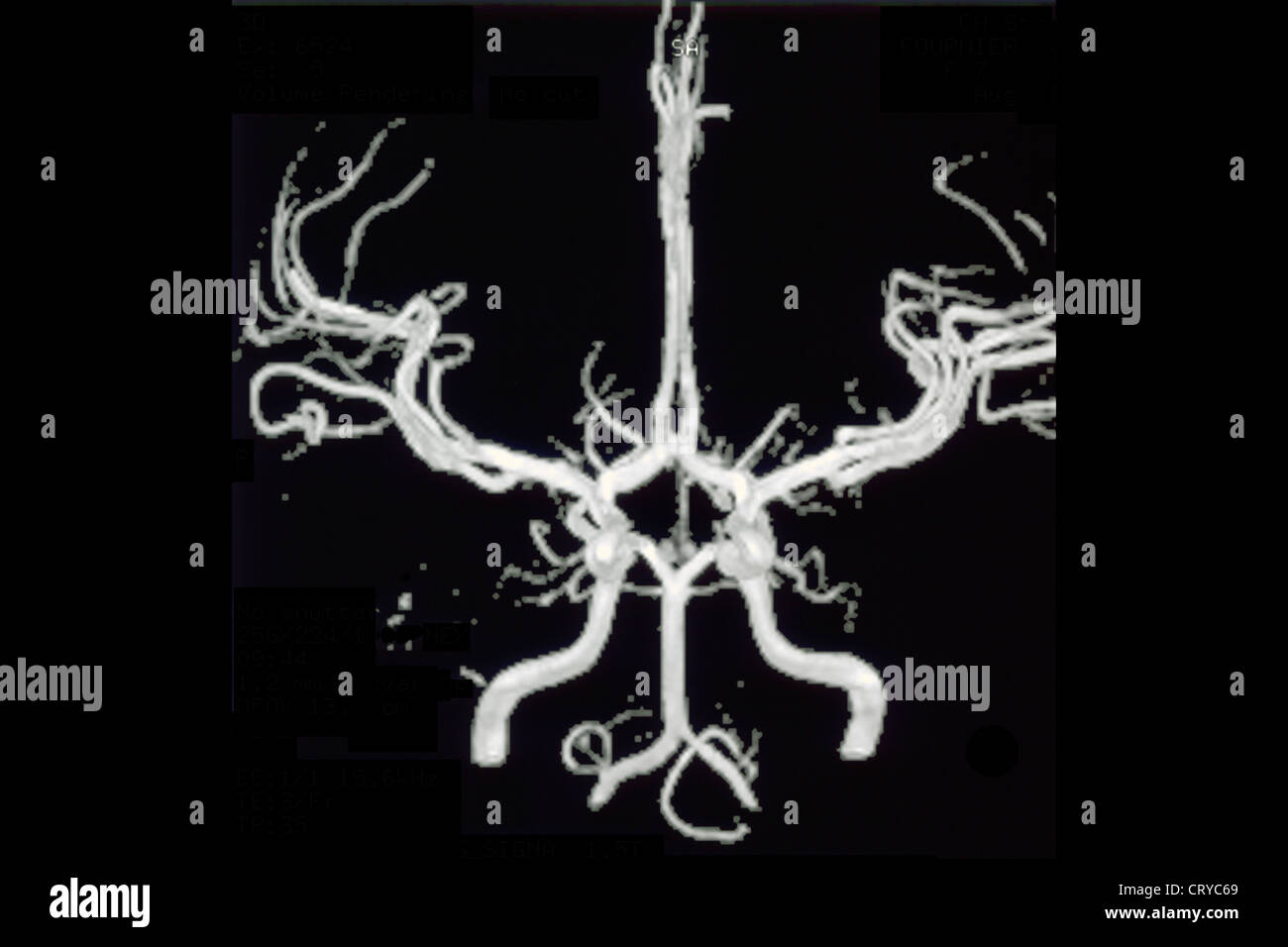 Circolo arterioso di willis immagini e fotografie stock ad alta ...