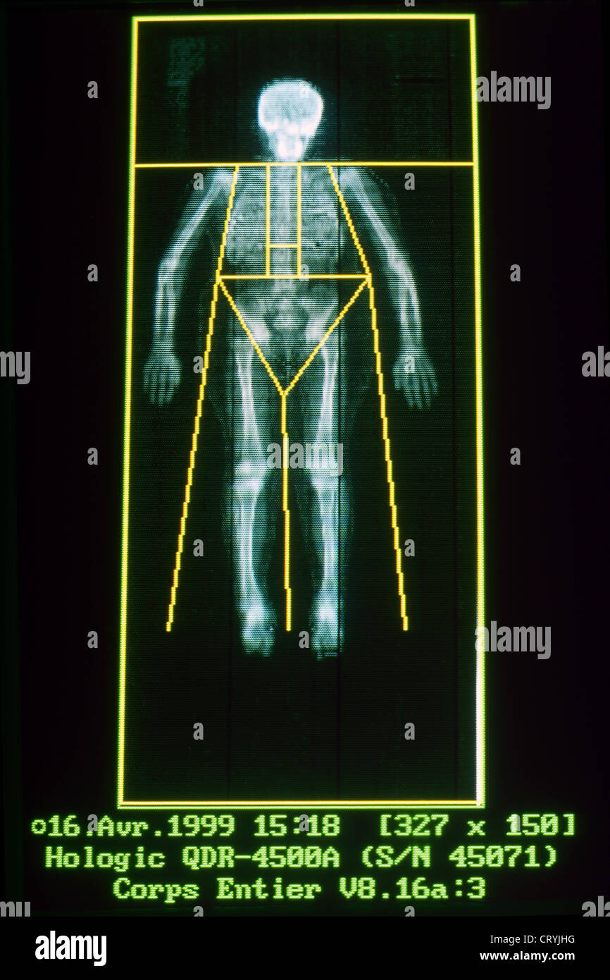 Osteogenesis imperfecta immagini e fotografie stock ad alta risoluzione ...