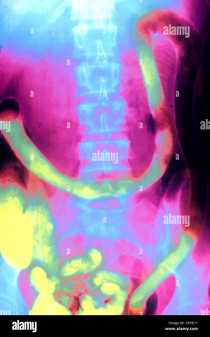 Rettocolite ulcerosa immagini e fotografie stock ad alta risoluzione ...