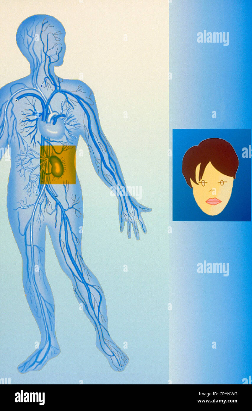 Morbo di addison immagini e fotografie stock ad alta risoluzione - Alamy