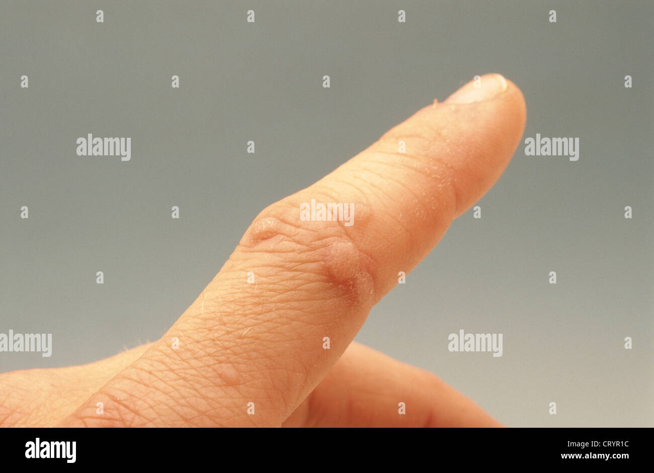 Verruca vulgaris immagini e fotografie stock ad alta risoluzione - Alamy