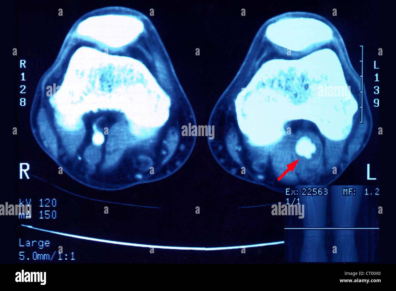 Arteria poplitea immagini e fotografie stock ad alta risoluzione - Alamy