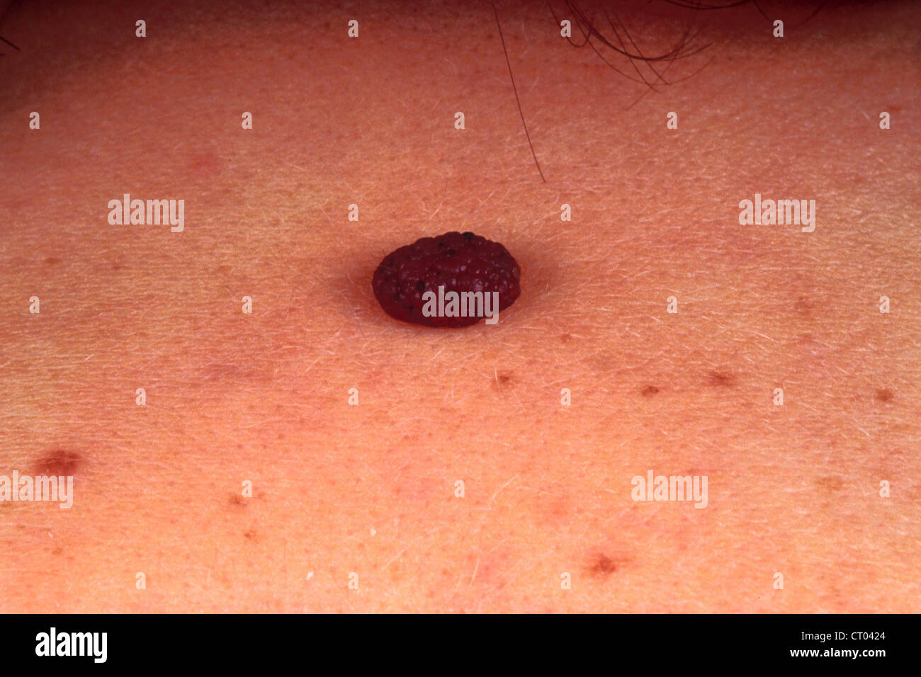 Verruche seborroiche immagini e fotografie stock ad alta risoluzione ...