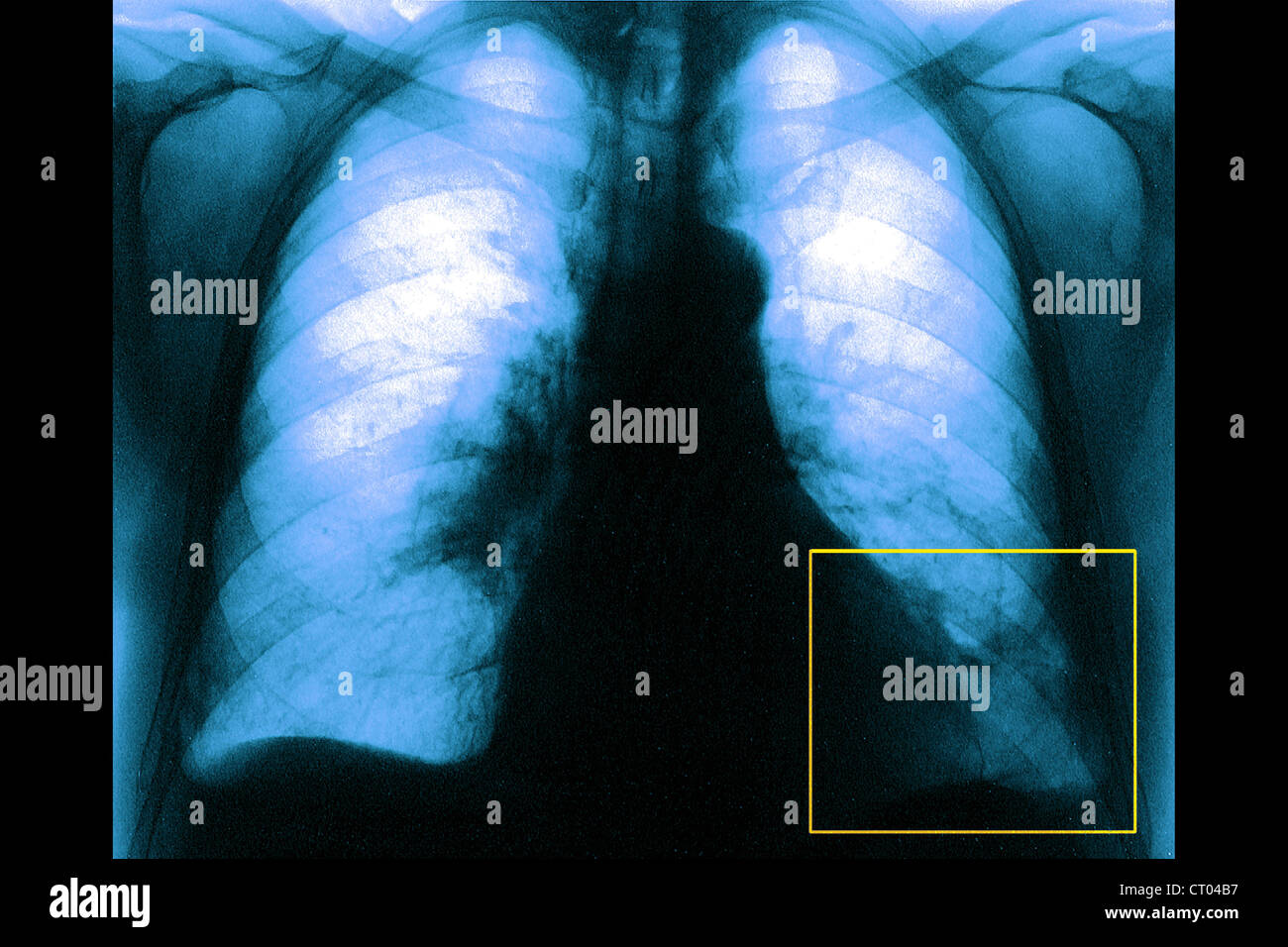Embolia polmonare immagini e fotografie stock ad alta risoluzione - Alamy