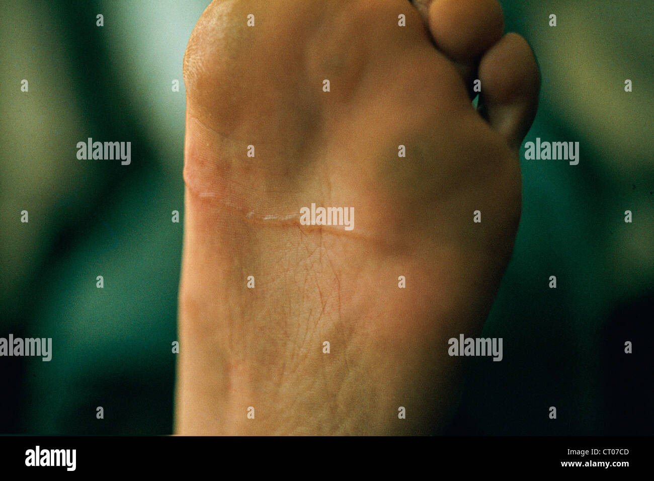 Larva migrans cutanea immagini e fotografie stock ad alta risoluzione ...