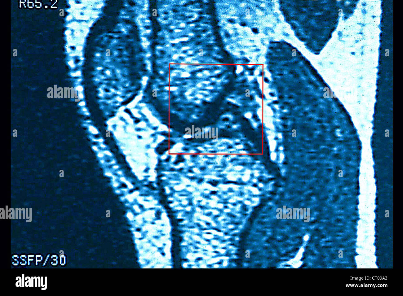 Legamento rotto immagini e fotografie stock ad alta risoluzione - Alamy