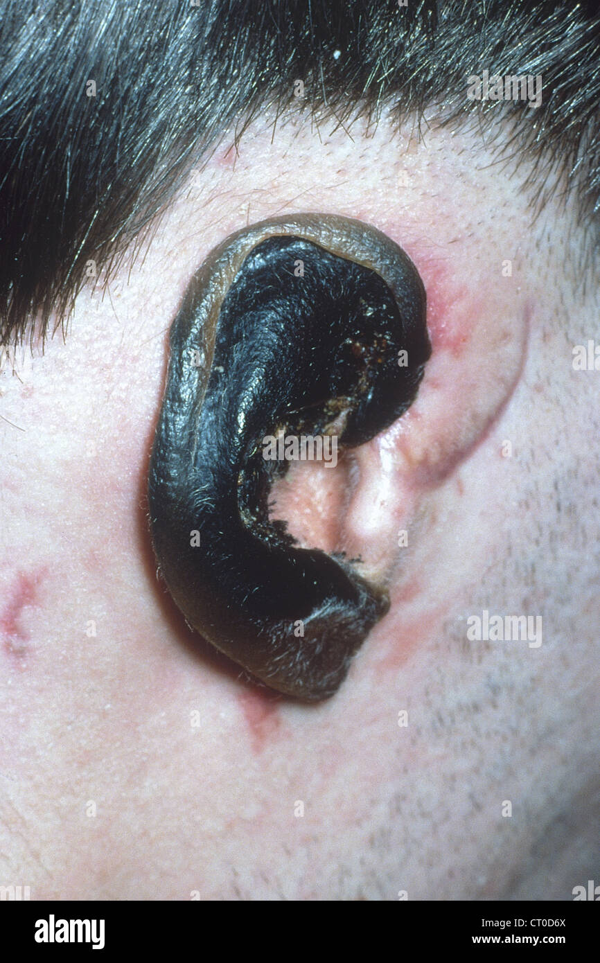 Necrosi cutanea immagini e fotografie stock ad alta risoluzione - Alamy
