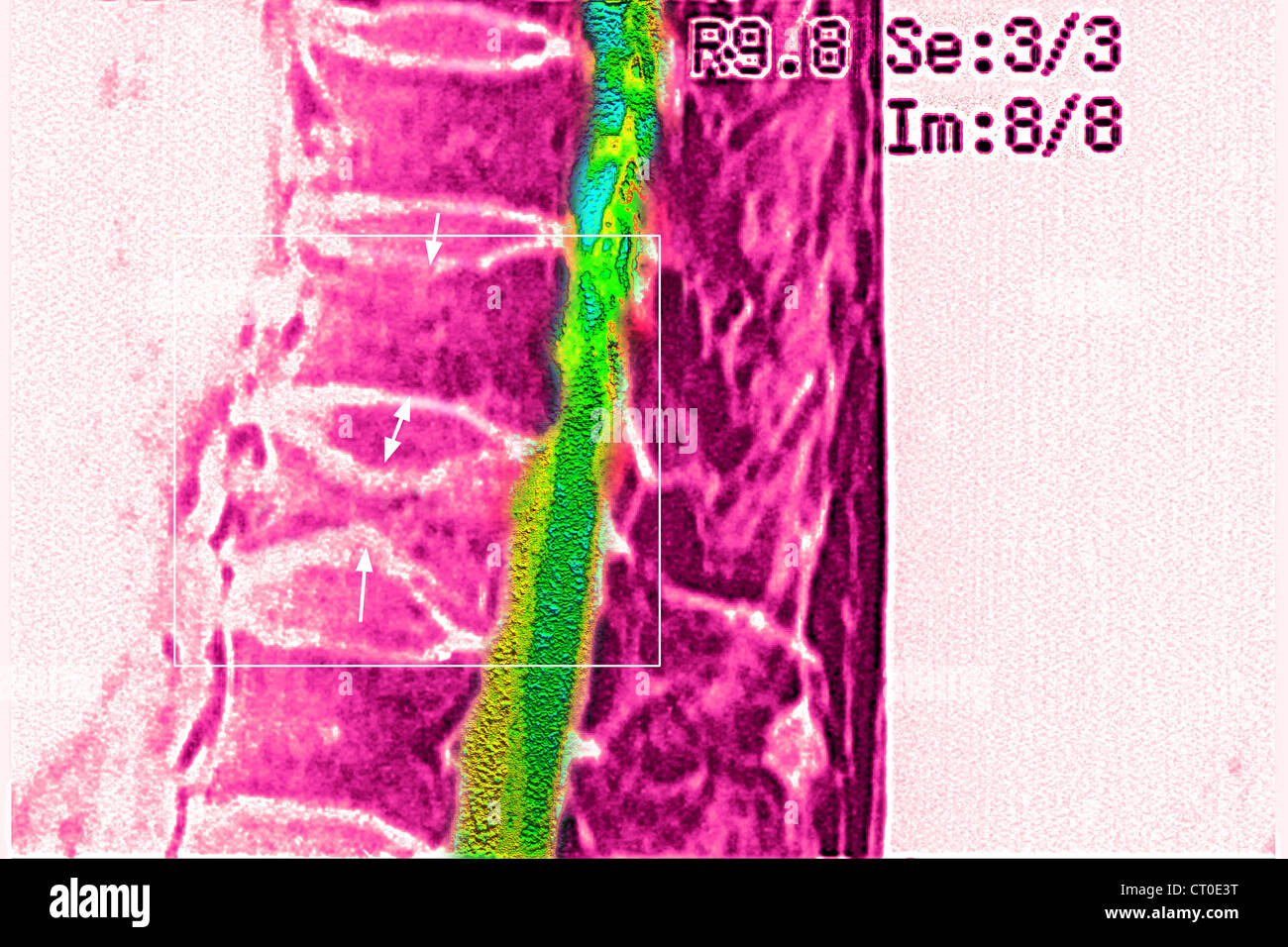 Mri di frattura da compressione lombare immagini e fotografie stock ad ...