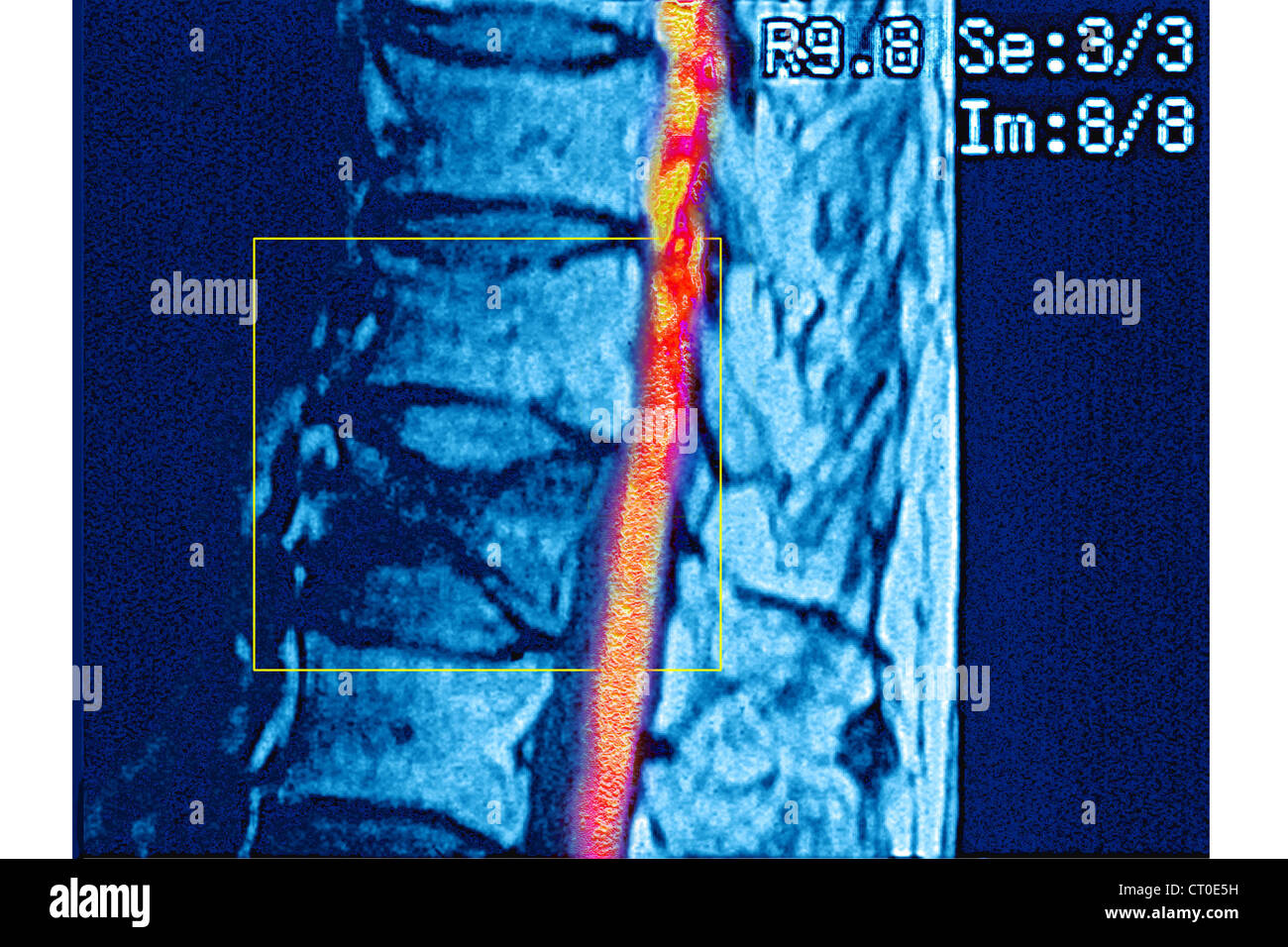 Mri di frattura da compressione lombare immagini e fotografie stock ad ...