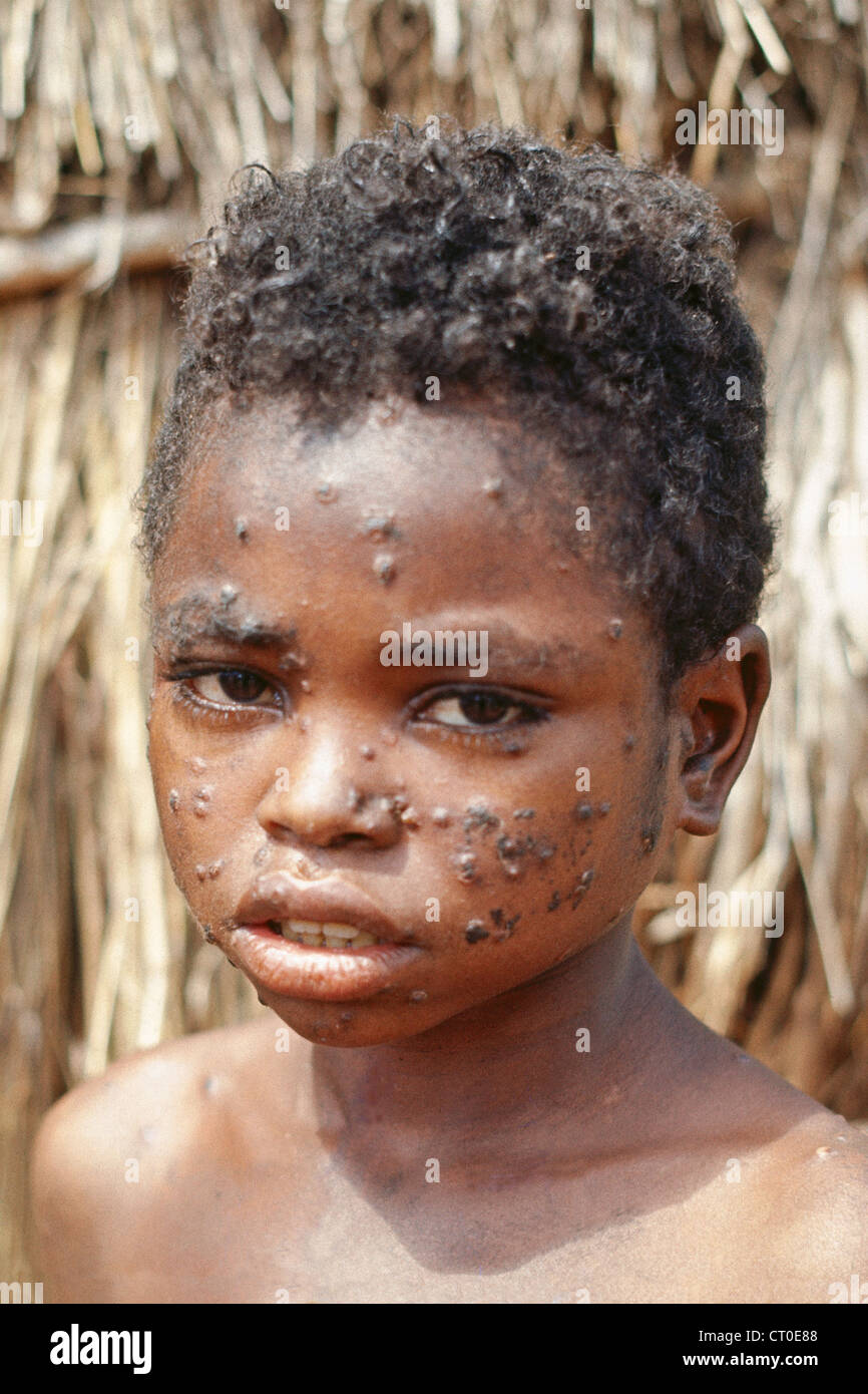 Bambino con vaiolo immagini e fotografie stock ad alta risoluzione - Alamy