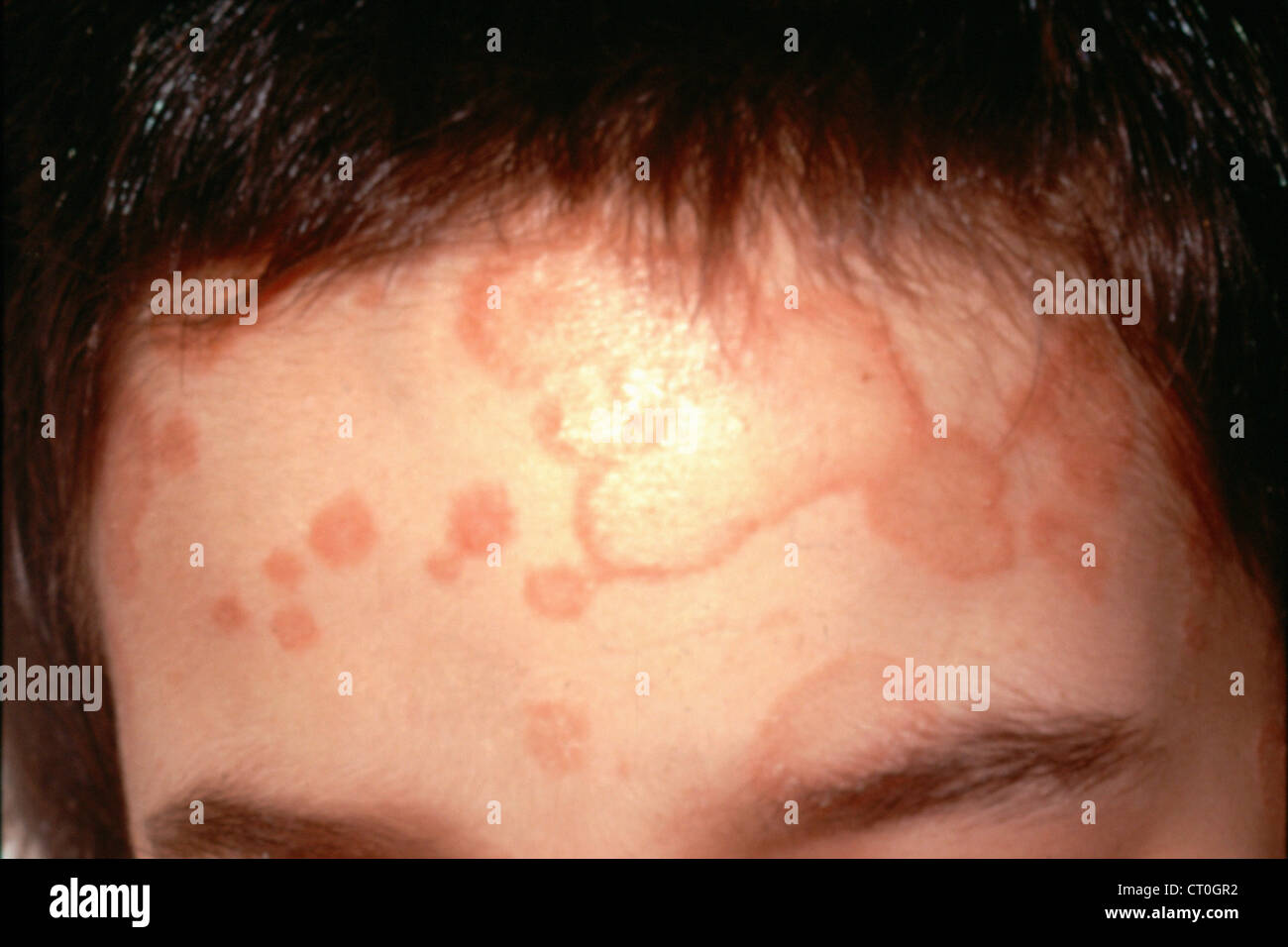 Tigna del cuoio capelluto immagini e fotografie stock ad alta ...