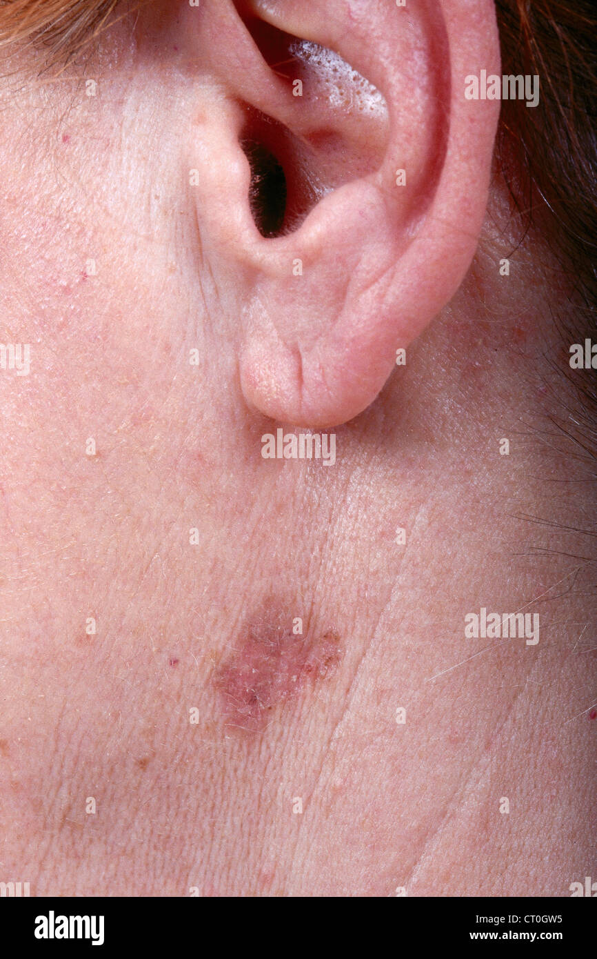 Basal cell carcinoma bcc immagini e fotografie stock ad alta ...