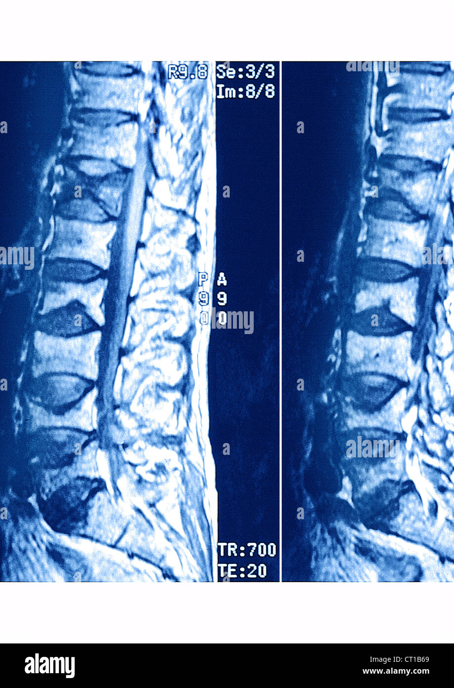 Mri di frattura da compressione lombare immagini e fotografie stock ad ...