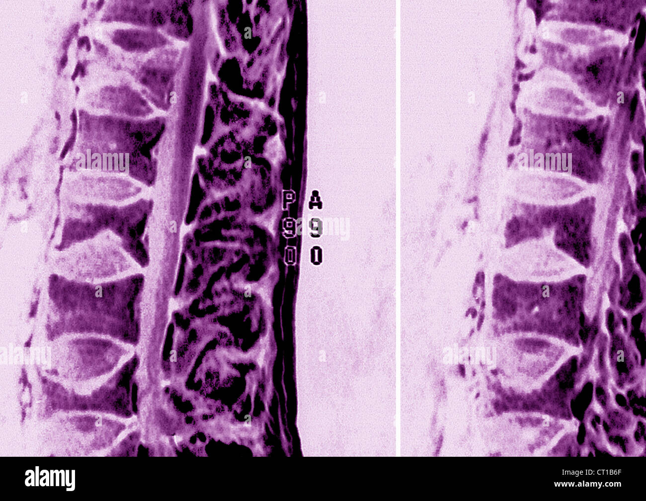 Mri di frattura da compressione lombare immagini e fotografie stock ad ...