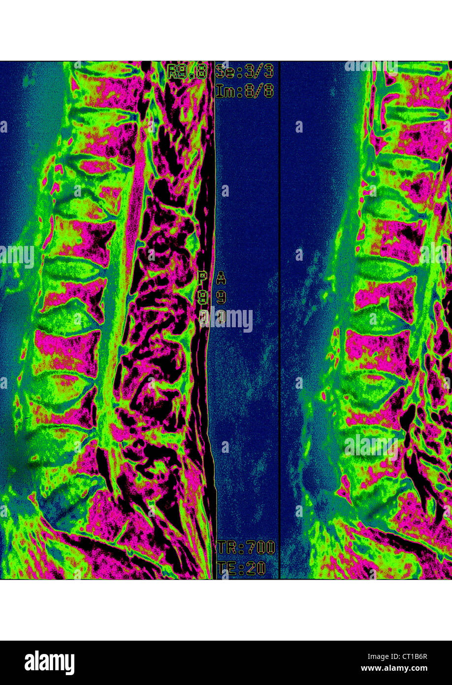 Mri di frattura da compressione lombare immagini e fotografie stock ad ...